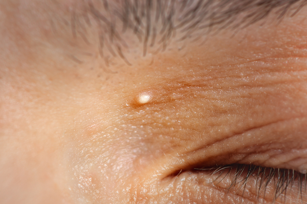 White Bumps On Skin Not Pimples